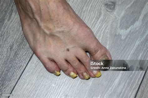 남자 발에 곰팡이가 클로즈업 손톱 곰팡이 감염 부러진 변색 된 부서진 손톱 피부 감염 발가락 진균증 곰팡이 감염 개념 손발톱 진균증 발톱 끝 아래 황갈색 반점 발톱에 대한