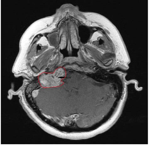 Mri Typical Tumour Location Download Scientific Diagram