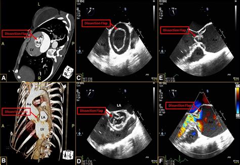 Type A Dissection Involving Intimo Intimal Intussusception T Aanda Practice