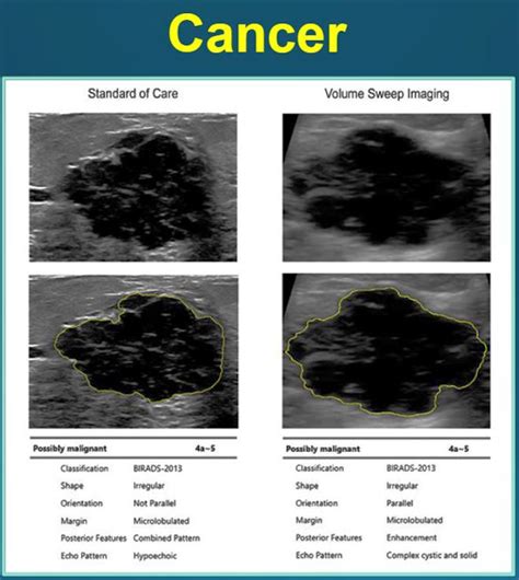 BÀi SoẠn VỀ SiÊu Âm ChẨn ĐoÁn Ultrasound Ai Method Diagnoses Breast