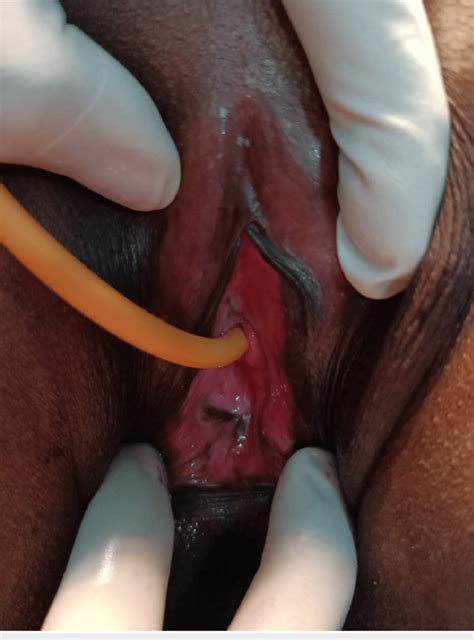 Pre Operative Vaginal Orifice With A Rim Of Fibrosed Tissue Download Scientific Diagram