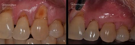Receding Gums Periodontist Wilmington