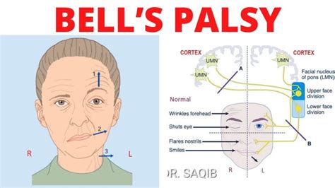 New Video On Bells Palsy Saqib Mansoor Posted On The Topic Linkedin