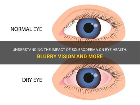 Understanding The Impact Of Scleroderma On Eye Health Blurry Vision And More Medshun