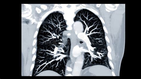 Ctpa Or Cta Pulmonary Artery For Diagnostic Pulmonary Embolism And X28pe