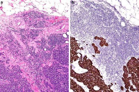 Acinic Cell Carcinoma With Tumor Associated Lymphoid Proliferation A