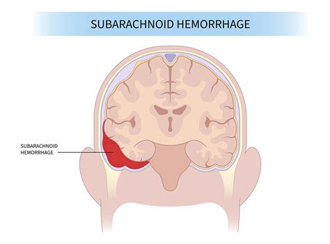 Subarachnoid Hemorrhage Symptoms Intracranial Hemorrhages Brain