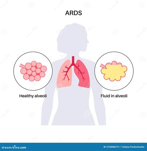 Ards Anatomical Poster Stock Vector Illustration Of Mild 275008679