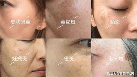 脸上长斑图片分析图解各种斑的区别图解 伤感说说吧