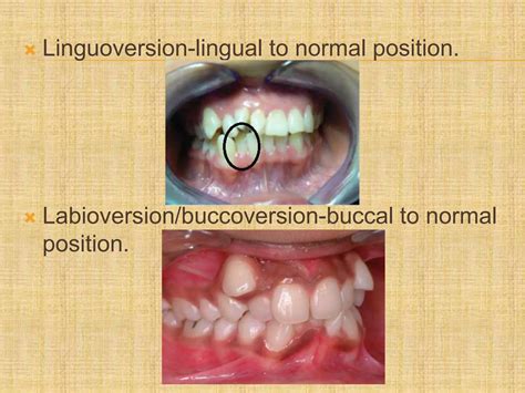 Modifications Of Angle`s Classification Pptx