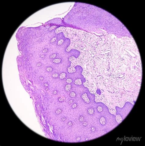 Buccal Mucosa Squamous Hyperplasia Show Hyperplastic Squamous Posters For The Wall • Posters