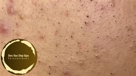 Blackhead Removal 06 Most Satisfying Blackhead Removal Sac Dep Spa New 2023 Youtube