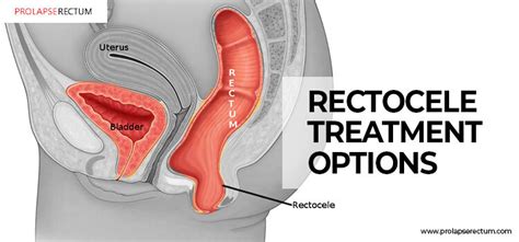 What Are Rectocele Treatment Options