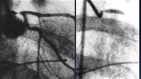 Left Main Revascularization What You Should Know