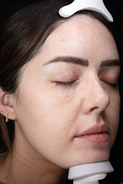 Moxi And BBL HERO Combination Treatment Elinea