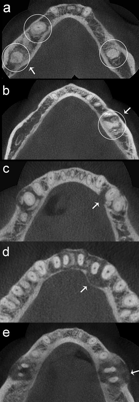 Axial And Cross Sectional Slices Of Cemento Osseous Dysplasia Cod Download Scientific Diagram