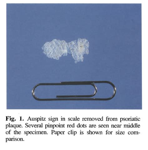 건선 편평태선 장미색비강진 비교
