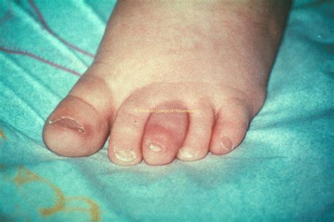 Juvenile Idiopathic Arthritis Rheumatology For Primary Care