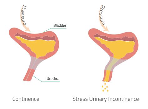 Causes Of Leaking Urine In Males At Mark Dunning Blog