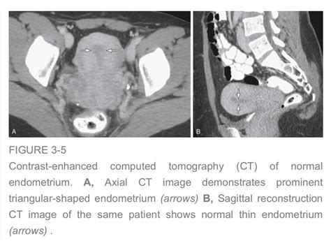 ANATOMY OF FEMALE REPRODUCTIVE TRACT ON USG PPTX