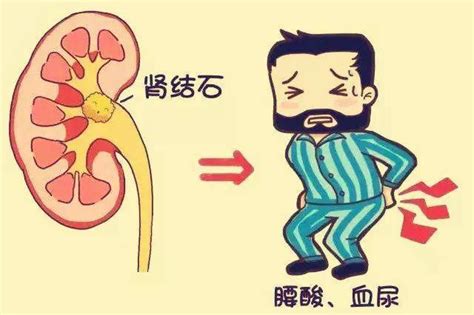为你揭开结石面纱 结石成分分析与预防 漯河市召陵区人民医院