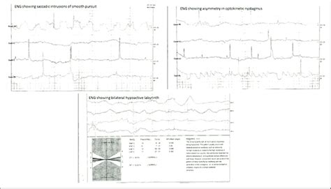 Eng Showing Saccadic Intrusions Of Smooth Pursuit Asymmetry Of Download Scientific Diagram