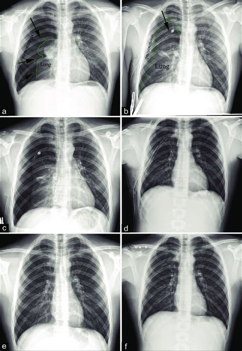 Pneumothorax Chest X Ray Medschool Eroppa