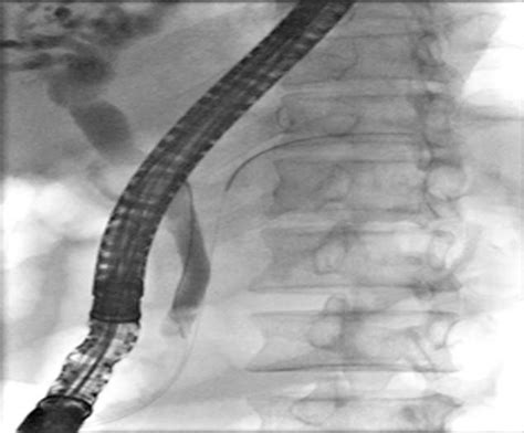 Novel Peroral Cholangioscopy Directed Lithotripsy Using An U Medicine
