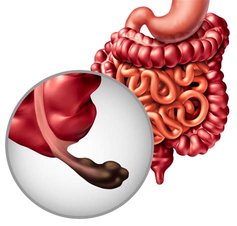 Basics Techniques Needed To Evaluate The Appendix Integrated Ultrasound Education