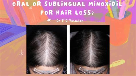Sublingual Or Oral Minoxidil For Hair Growth Dermatologist Explains