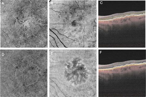 Double Layer Sign In Chorioretinal Diseases Clinical Significance And