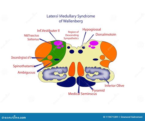 Wallenberg Syndrome Lateral Medullary Syndrome Of Wallenberg Rismed