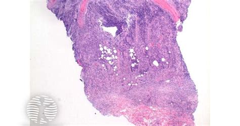 Primary Cutaneous Diffuse Large B Cell Lymphoma Pathology Image
