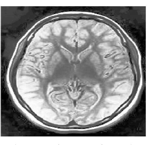 figure 2 from enhancement of mri brain images with histogram