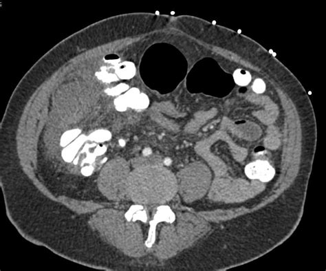 Acute Cholecystitis Liver Radiology Case Studies Ctisus Ct Scanning