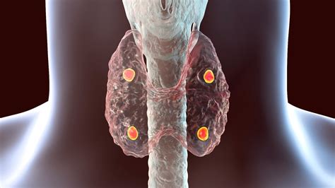 Hyperparathyroidism What It Is What Are The Symptoms Treatment