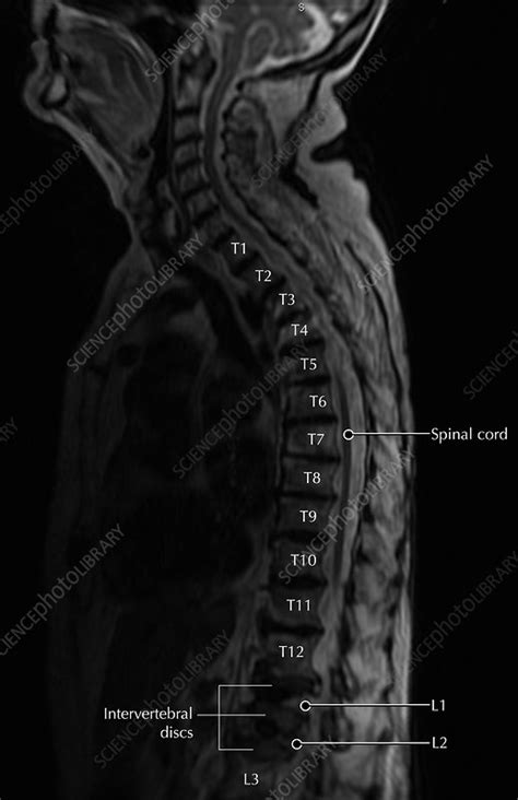 Lumbar Compression Fracture Stock Image C027 1214 Science Photo