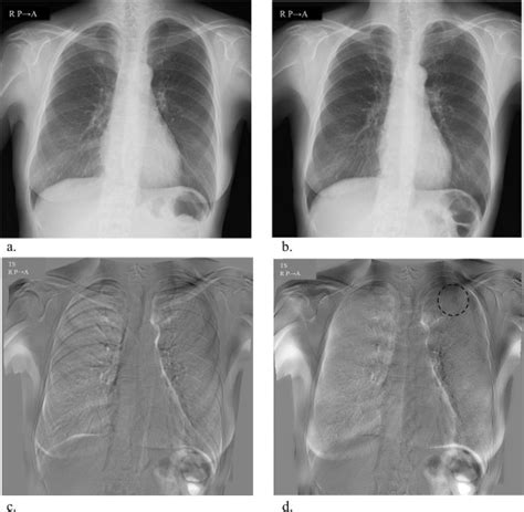 Evaluation Of The Clinical Utility Of Temporal Subtraction Using Bone Suppression Processing In