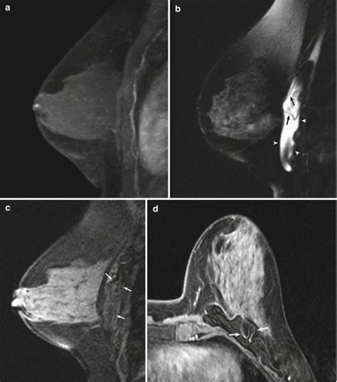 Breast Implants Radiology Key