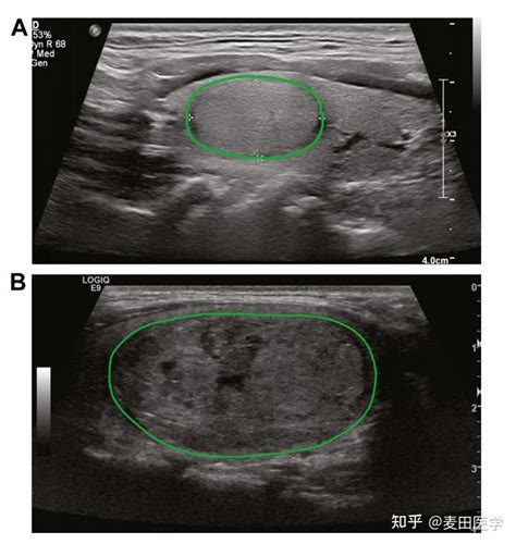 文献速递：多模态影像组学文献分享：生成一种多模态人工智能模型以区分甲状腺良性和恶性滤泡性肿瘤：概念验证研究 知乎
