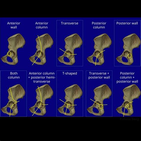 Classification Acetabular Fractures Judet Letournel 52 Off