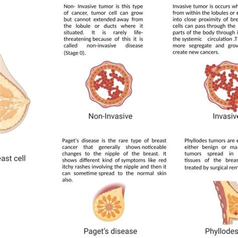 Histological Type Of Breast Cancer Download Scientific Diagram
