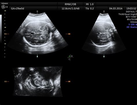 Choroid Plexus Cyst Looking Through A Transducer