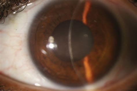 Slit Lamp Anterior Segment Image Indicating Central Corneal Opacity Download Scientific Diagram