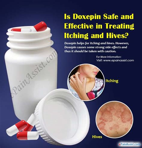 Is Doxepin Safe And Effective In Treating Itching And Hives