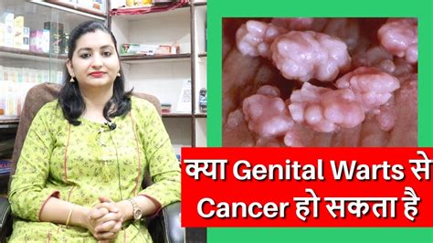 Female Genital Warts