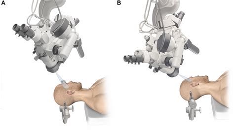 Sylvian Keyhole Approach Case A Native Time Of Flight Angiography Download Scientific