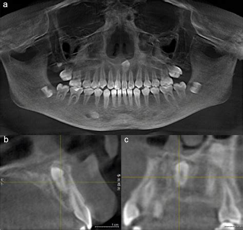 Pre Operative Cbct Data Of The Patient A Preoperative Cbct Picture Download Scientific Diagram