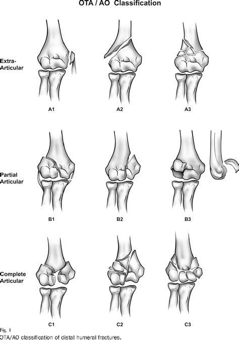 Types Of Elbow Fracture At Annette Nelson Blog