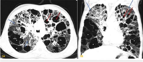 Ct Scans Showed Centrilobular And Paraseptal Emphysema Stars Download Scientific Diagram
